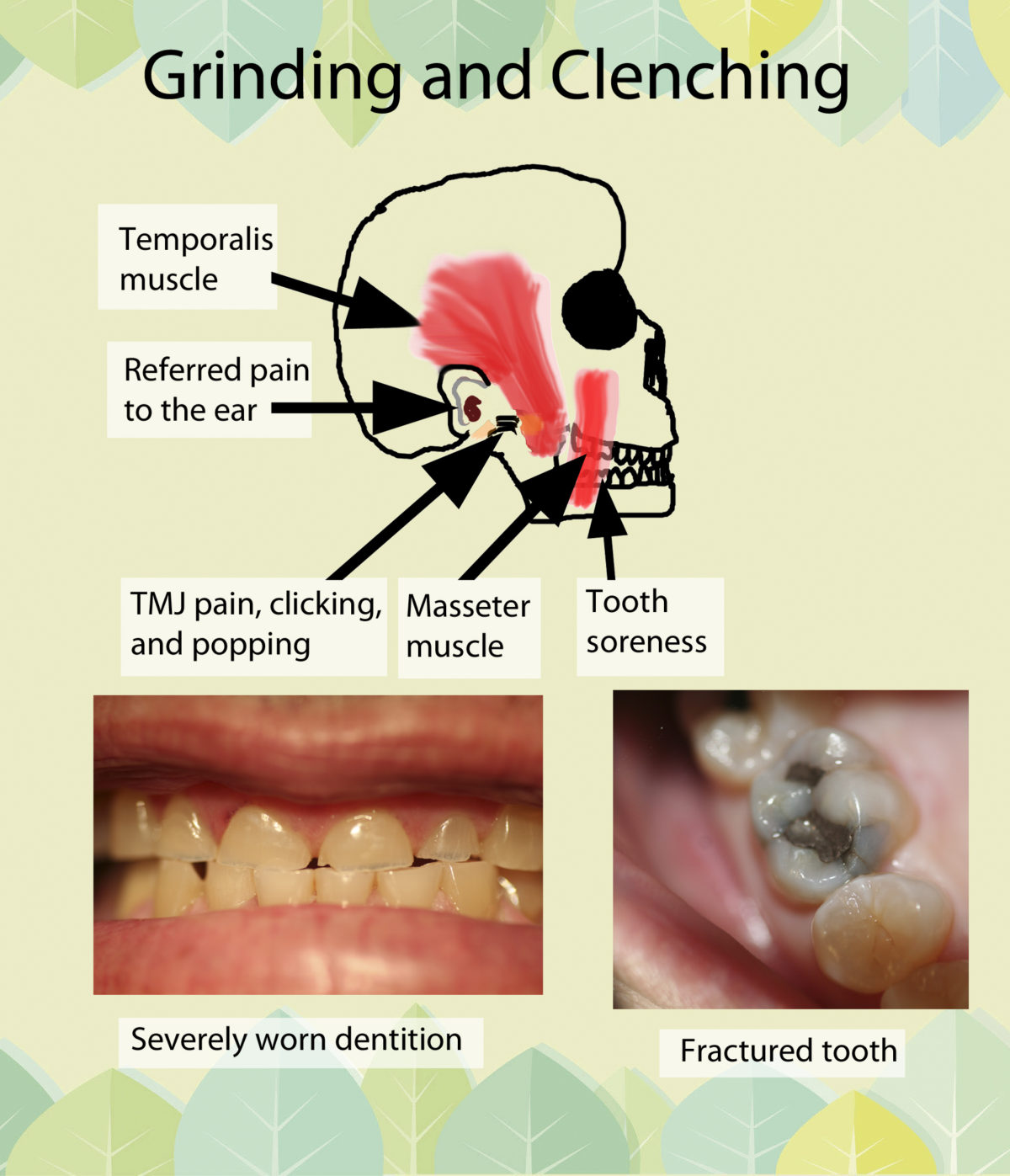 Grinding and Clenching – McFarlane Dental