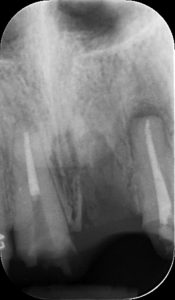Bicycle Accident – Dental Implant Replacement Case – McFarlane Dental