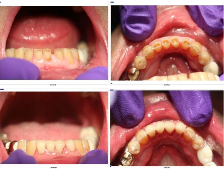 Erosion, the Slow Path to Tooth Destruction Reversed – McFarlane Dental