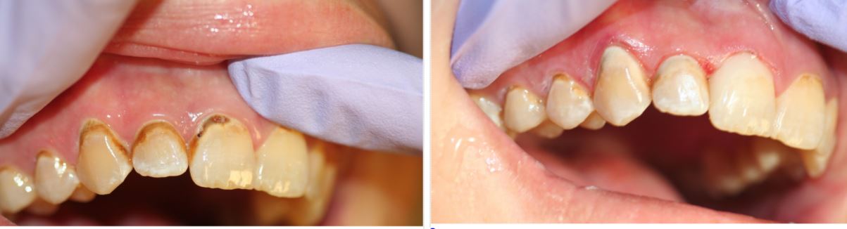 Remineralization is Real: reversing bracket scars and discolored roots ...
