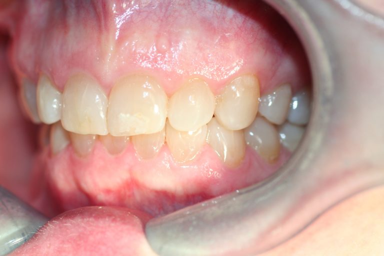 Before and After Invisalign Class II div 2 – McFarlane Dental