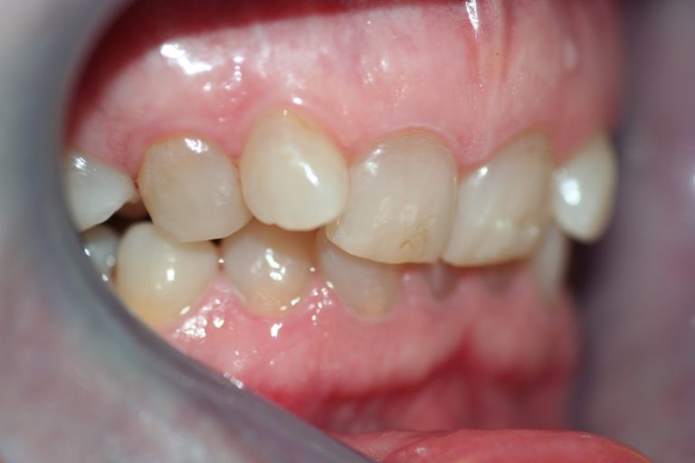 Before and After Invisalign Class II div 2 – McFarlane Dental