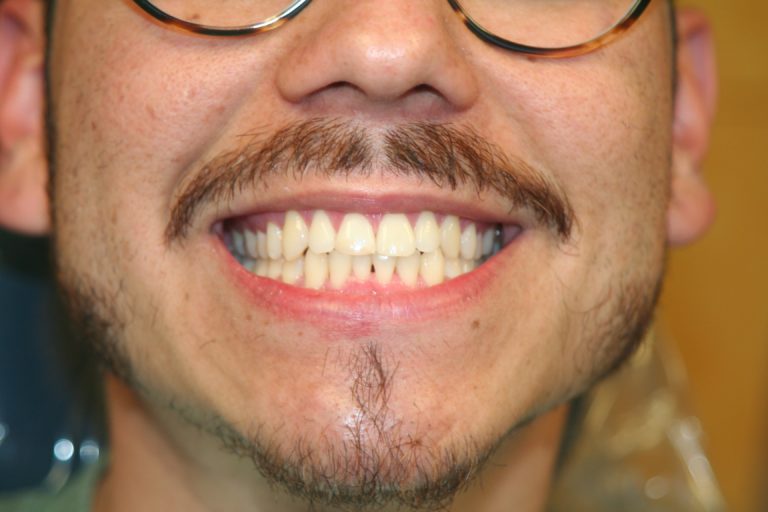 How Does Internal Bleaching Work? – McFarlane Dental