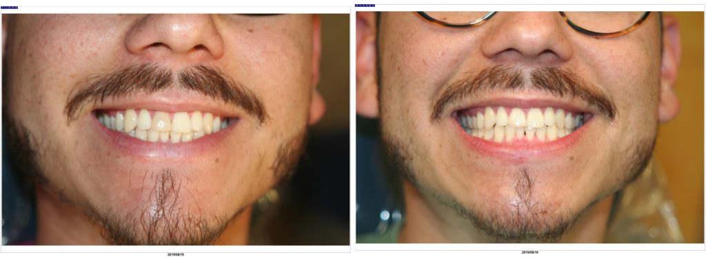 How Does Internal Bleaching Work? – McFarlane Dental