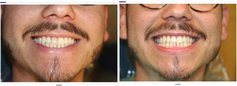 How Does Internal Bleaching Work? – McFarlane Dental