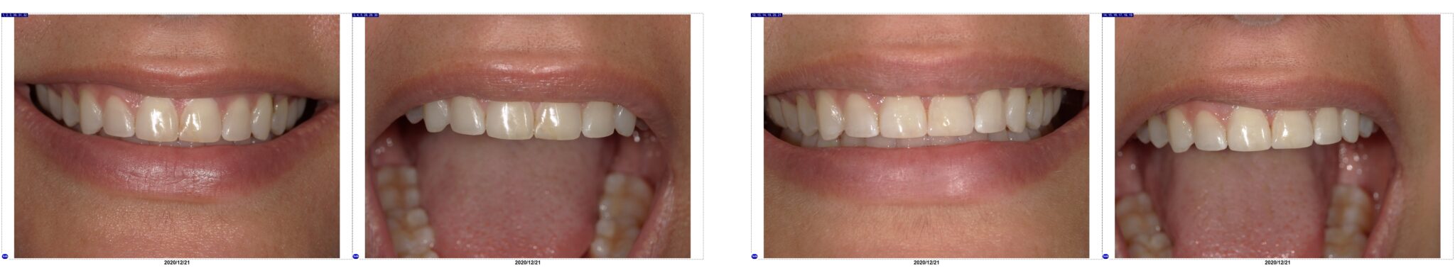 Esthetic Correction of Failed Color Match – McFarlane Dental