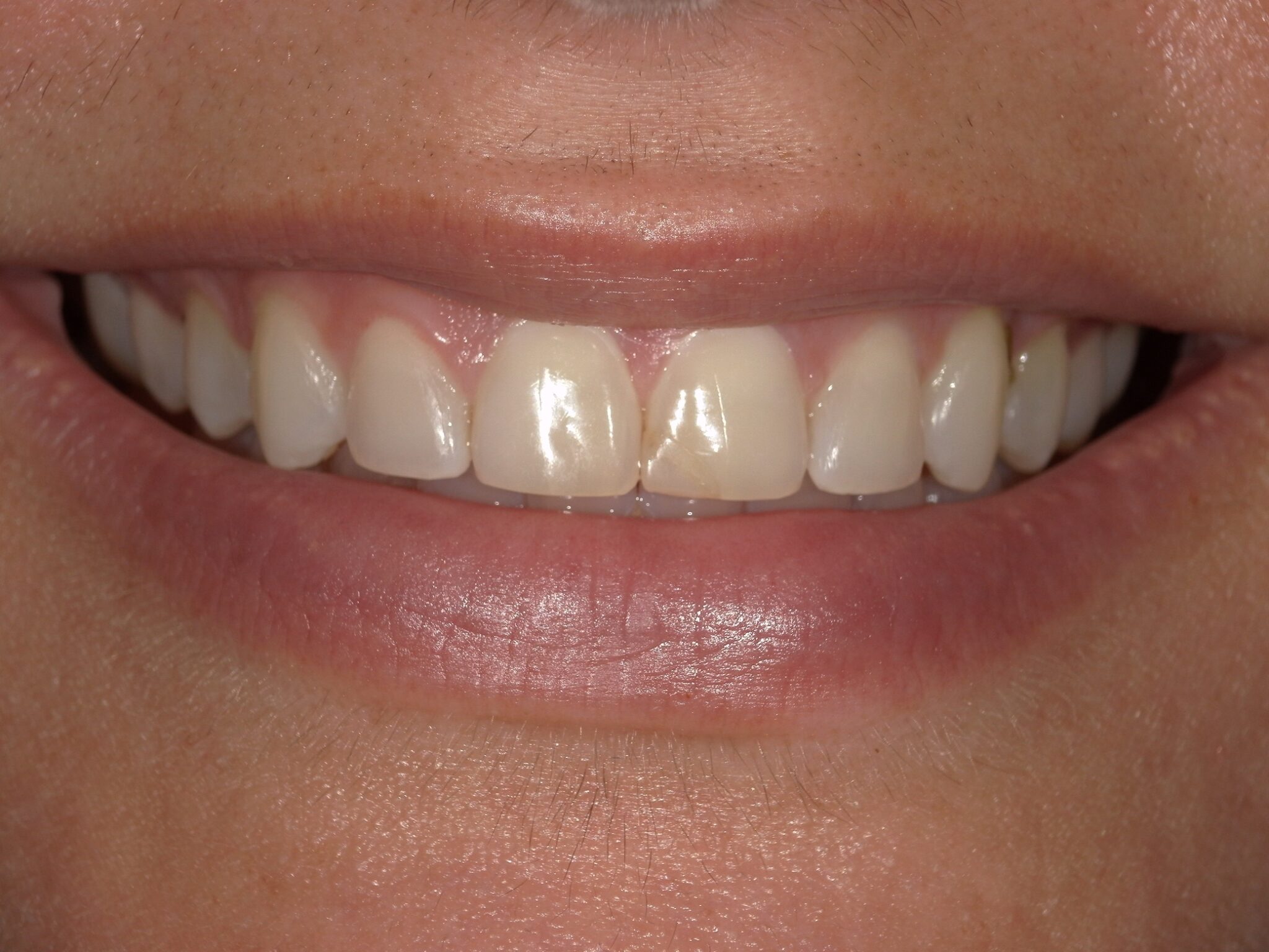 Esthetic Correction of Failed Color Match – McFarlane Dental