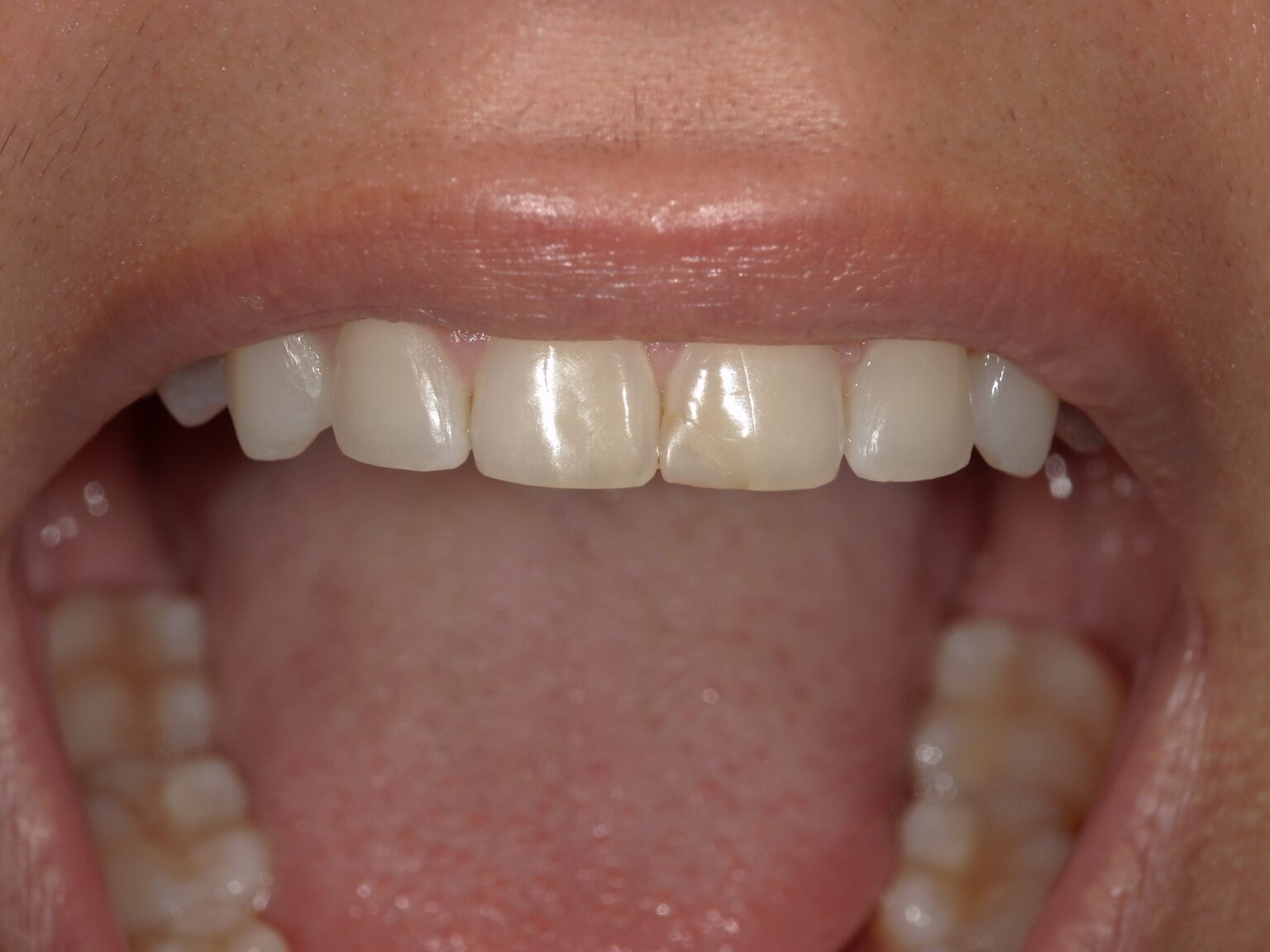 Esthetic Correction of Failed Color Match – McFarlane Dental